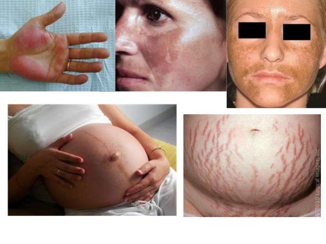 Physiological Changes During Pregnancy