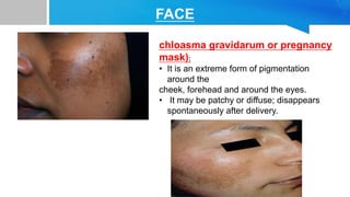 Chloasma Gravidarum