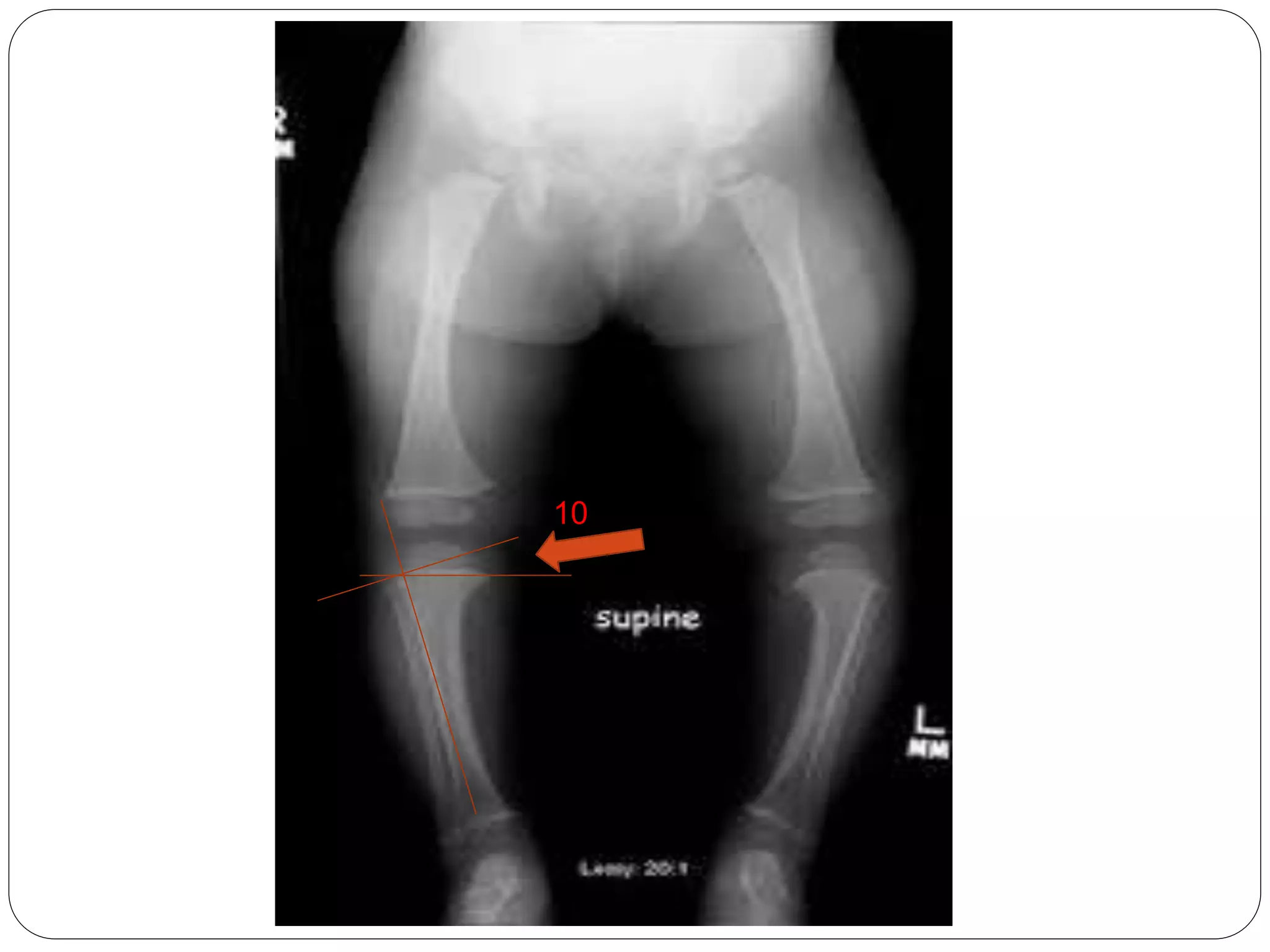 Physiological & pathological tibia vara | PPT