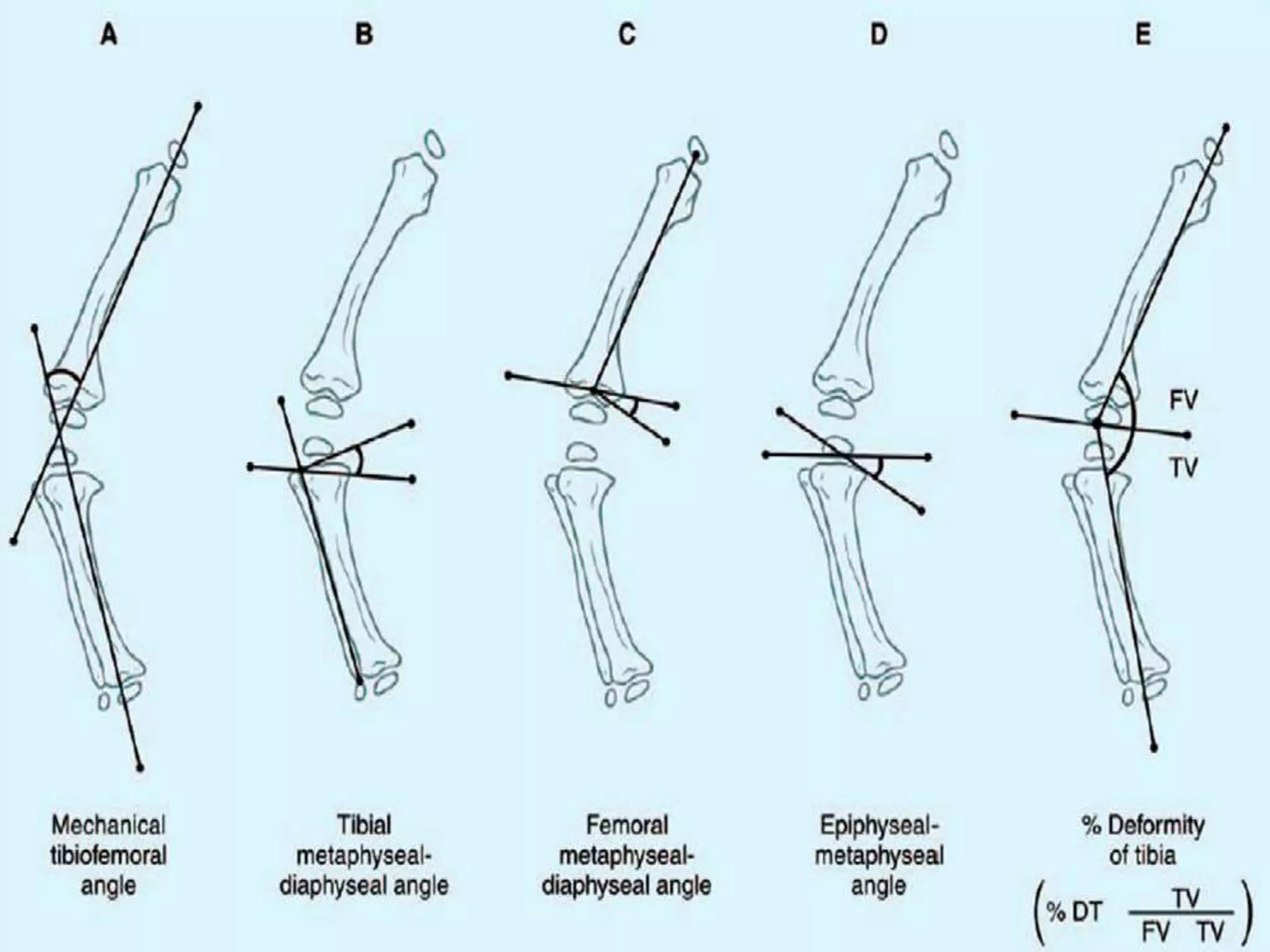 Physiological & pathological tibia vara | PPT
