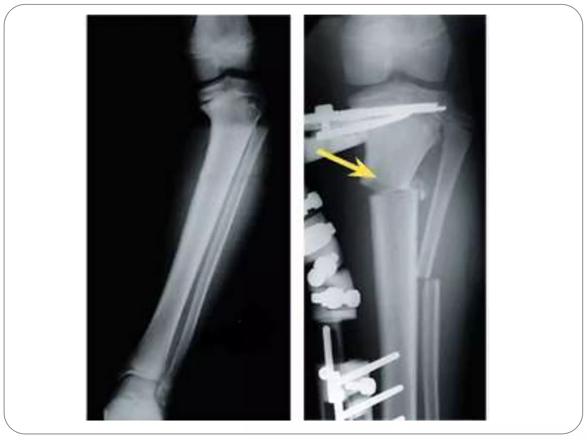 Physiological & pathological tibia vara | PPT