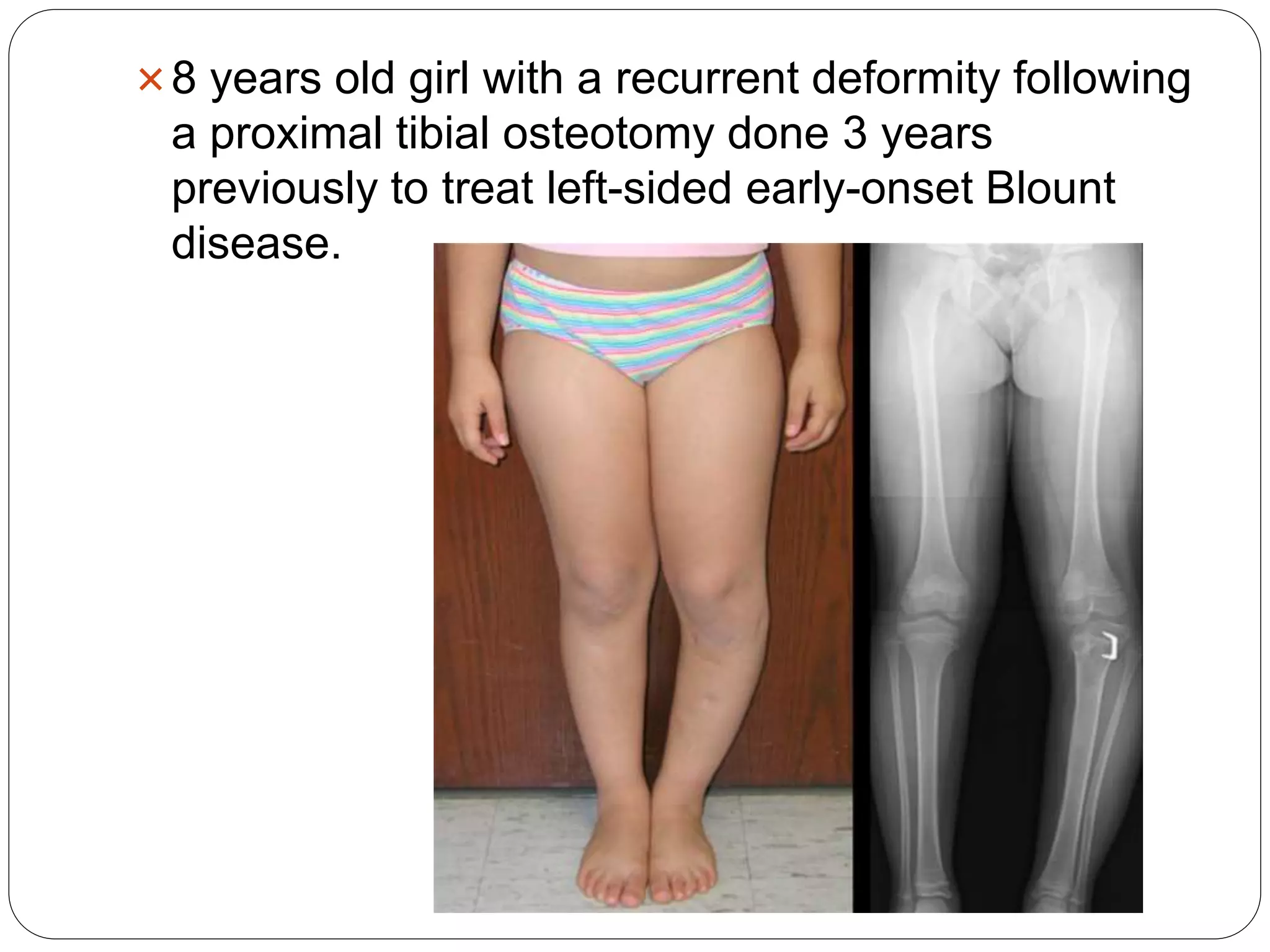 Physiological & pathological tibia vara | PPT