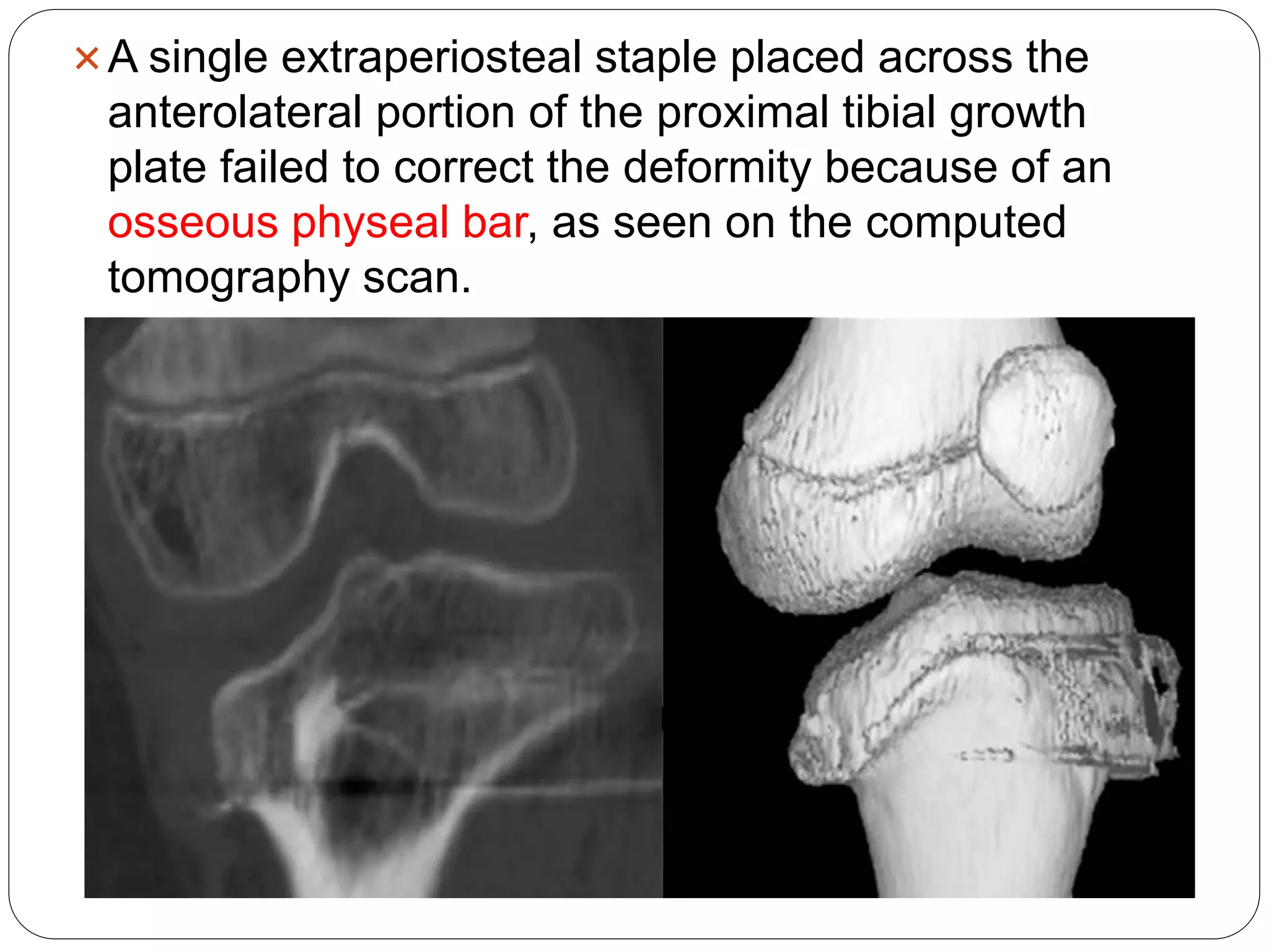 Physiological & pathological tibia vara | PPT