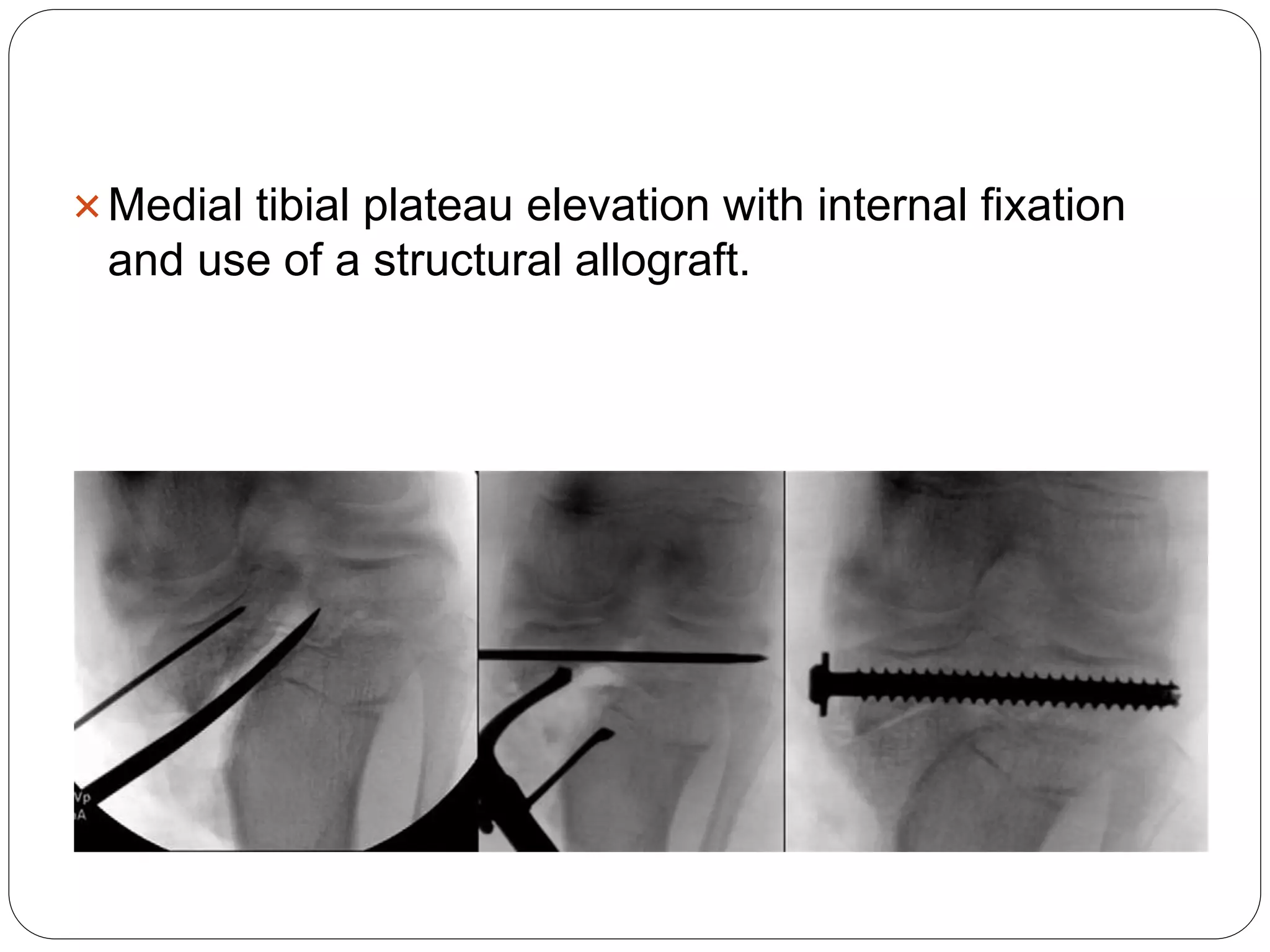Physiological & pathological tibia vara | PPT