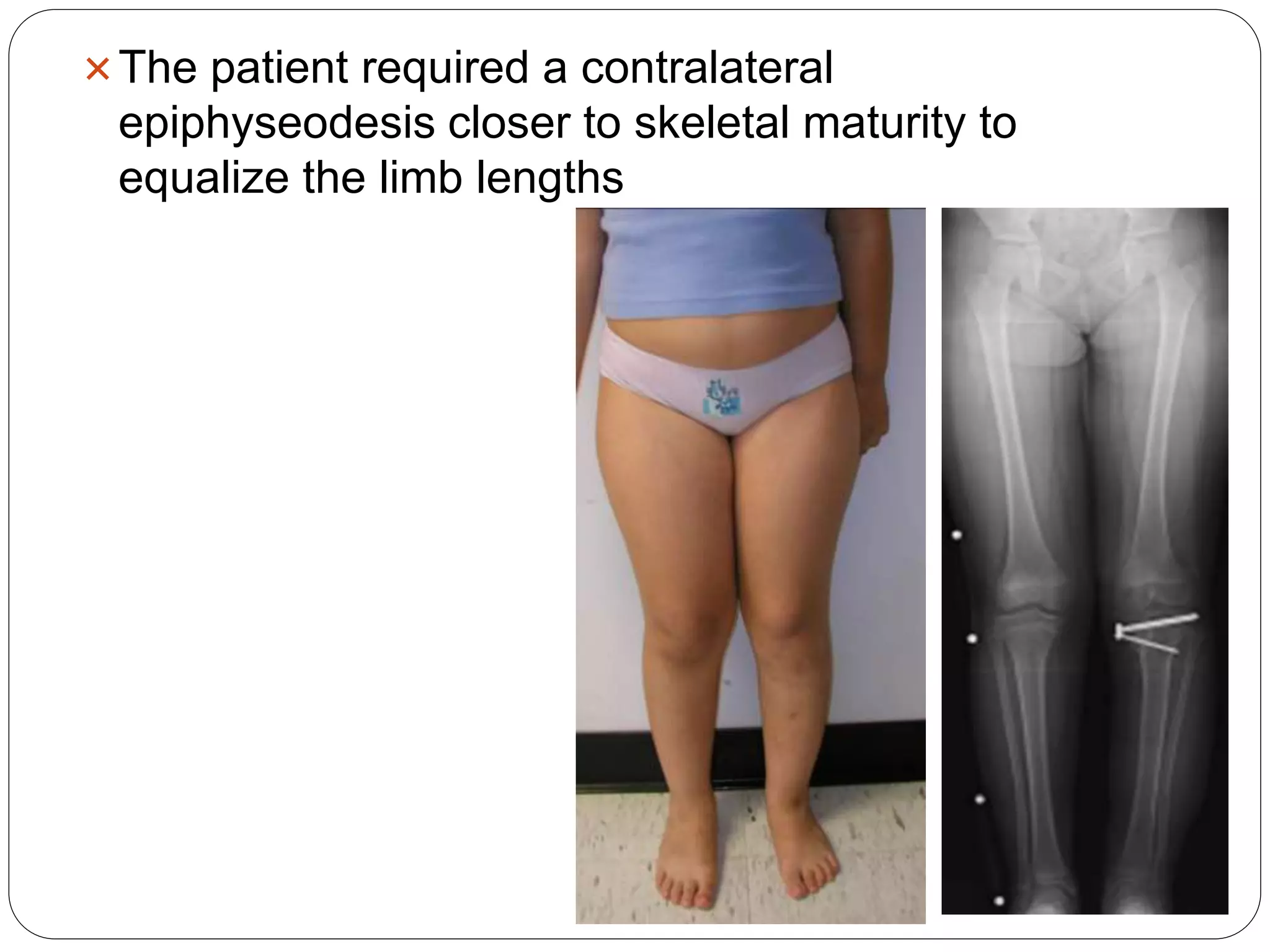 Physiological & pathological tibia vara | PPT