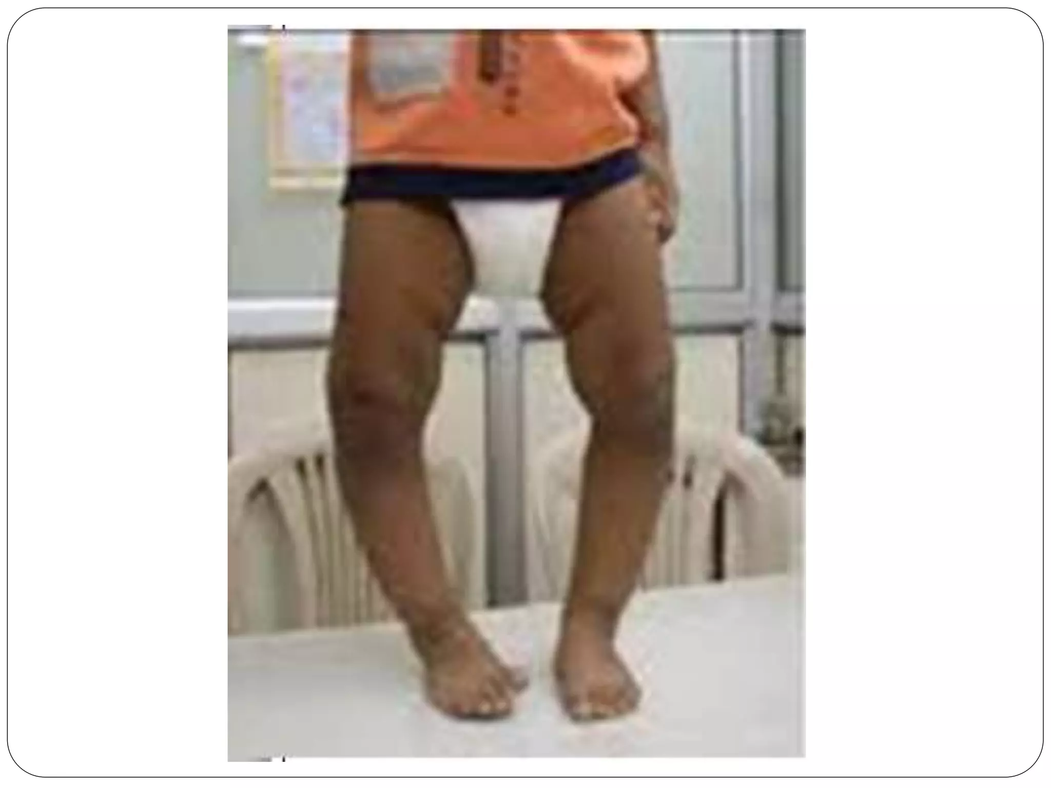 Physiological & pathological tibia vara | PPT