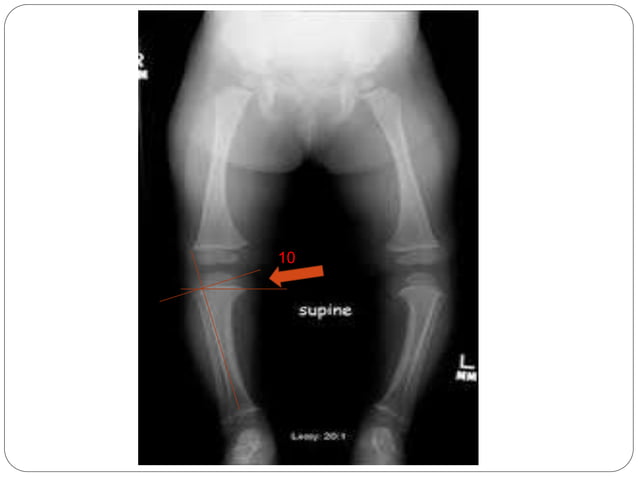 Physiological & pathological tibia vara | PPT | Death, Injury, or ...