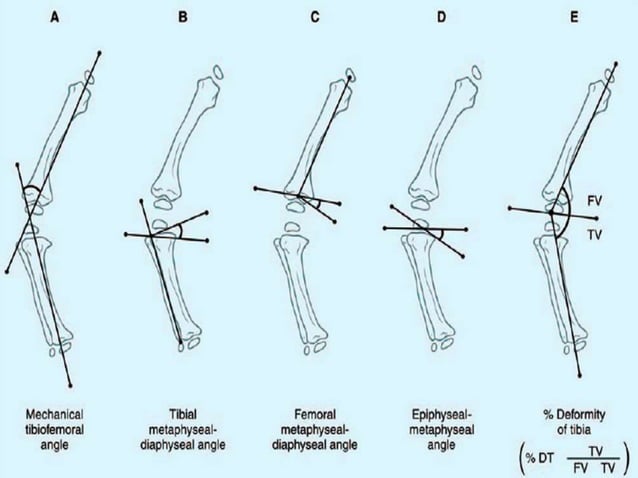 Physiological & pathological tibia vara | PPT | Death, Injury, or ...