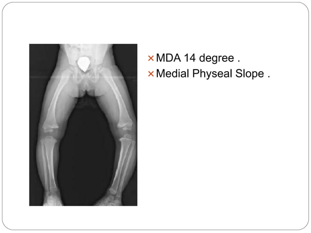 Physiological & pathological tibia vara | PPT | Death, Injury, or Military Conflict | Sensitive ...