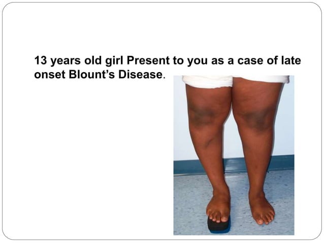 Physiological & pathological tibia vara | PPT | Death, Injury, or Military Conflict | Sensitive ...