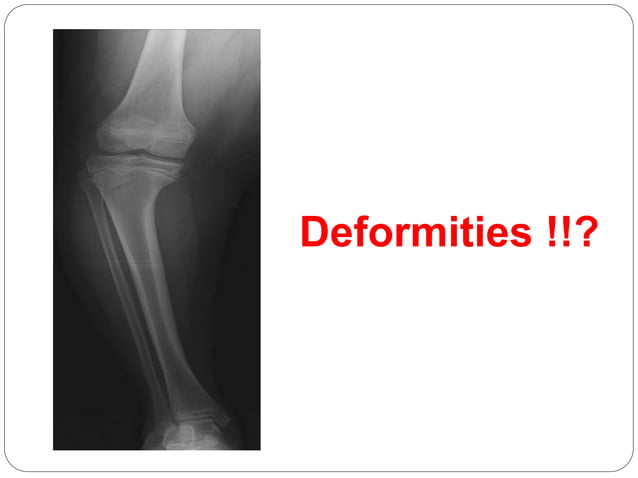 Physiological & pathological tibia vara | PPT | Death, Injury, or ...