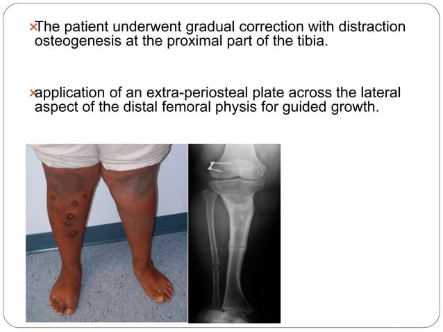 Physiological & pathological tibia vara | PPT | Death, Injury, or ...