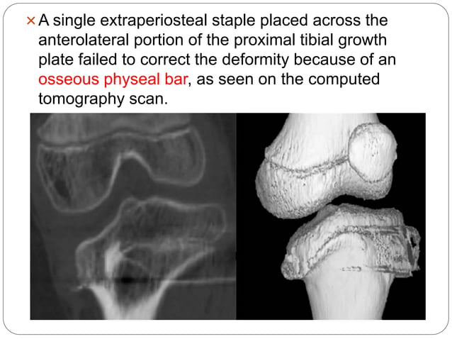 Physiological & pathological tibia vara | PPT | Death, Injury, or ...