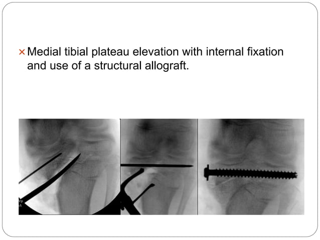 Physiological & pathological tibia vara | PPT | Death, Injury, or ...