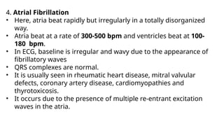 Cardiac Arrhythmias Physiology and ECG changes | PPTX