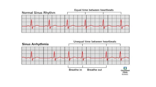 Cardiac Arrhythmias Physiology and ECG changes | PPT