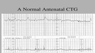 PHYSIOLOGY OF DOING CTG gynaecology.pptx