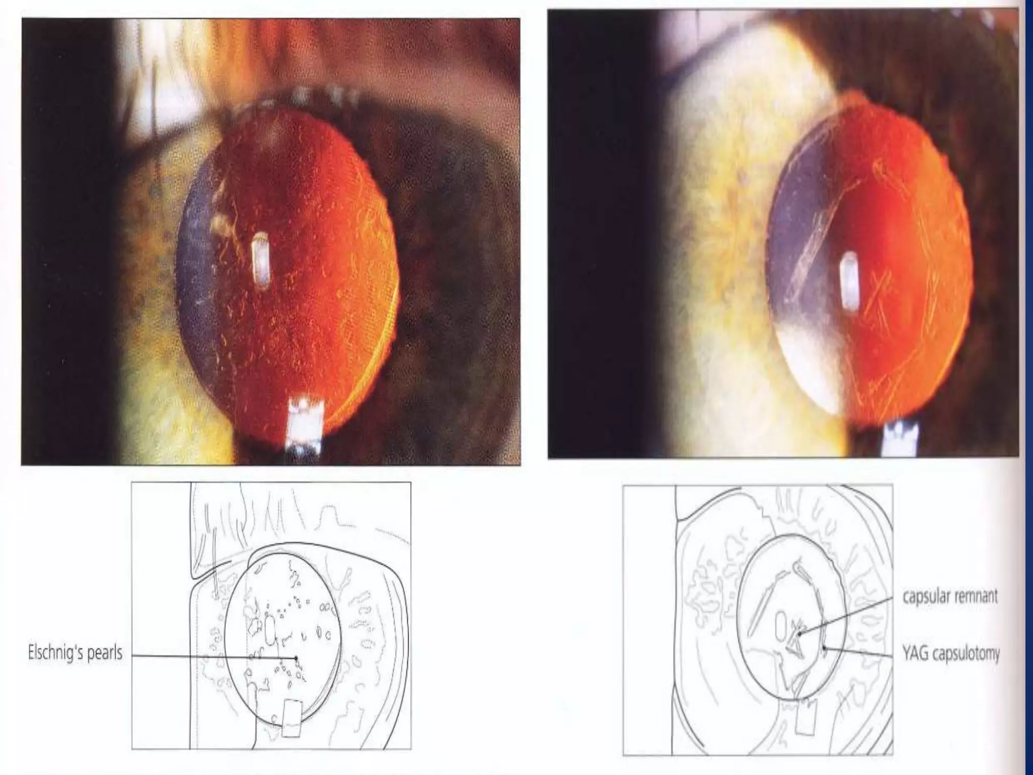 Physiology of lens and cataractogenesis | PPTX