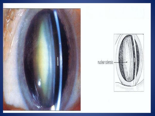 Physiology of lens and cataractogenesis | PPT
