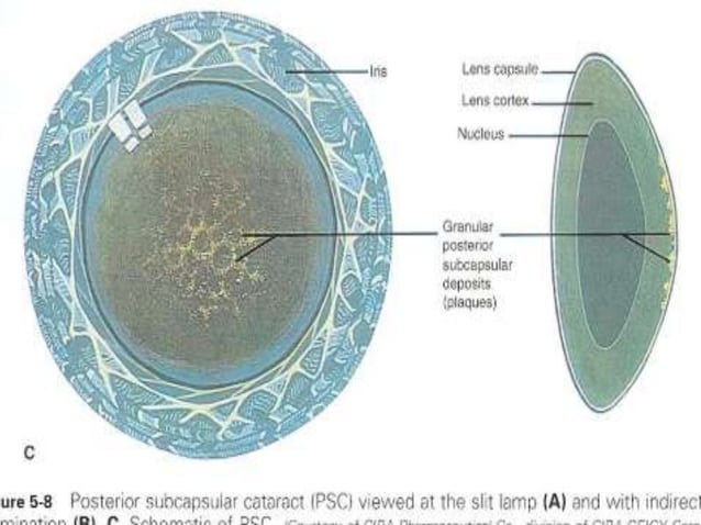 Physiology of lens and cataractogenesis | PPT