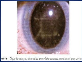 Snowflake Cataract