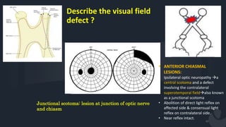 Physiology of the visual pathway & cerebral integration | PPTX