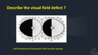 Physiology of the visual pathway & cerebral integration | PPTX