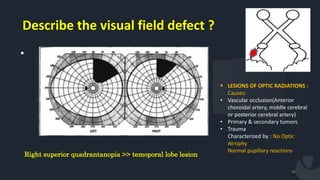 Physiology of the visual pathway & cerebral integration | PPTX