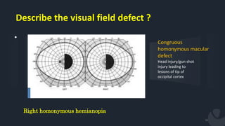 Physiology of the visual pathway & cerebral integration | PPTX