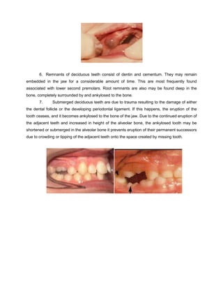 Physiology of tooth eruption | PDF
