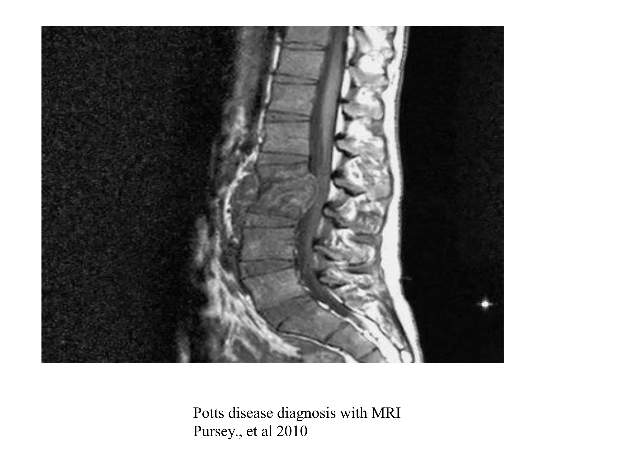 PHYSIOTHERAPY ASSESSMENT IN PATIENT WITH CAUDAL EQUINAL SYNDROME | PPTX ...