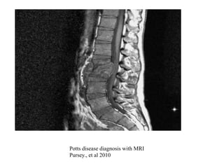 PHYSIOTHERAPY ASSESSMENT IN PATIENT WITH CAUDAL EQUINAL SYNDROME | PPTX