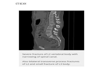 PHYSIOTHERAPY ASSESSMENT IN PATIENT WITH CAUDAL EQUINAL SYNDROME | PPTX ...
