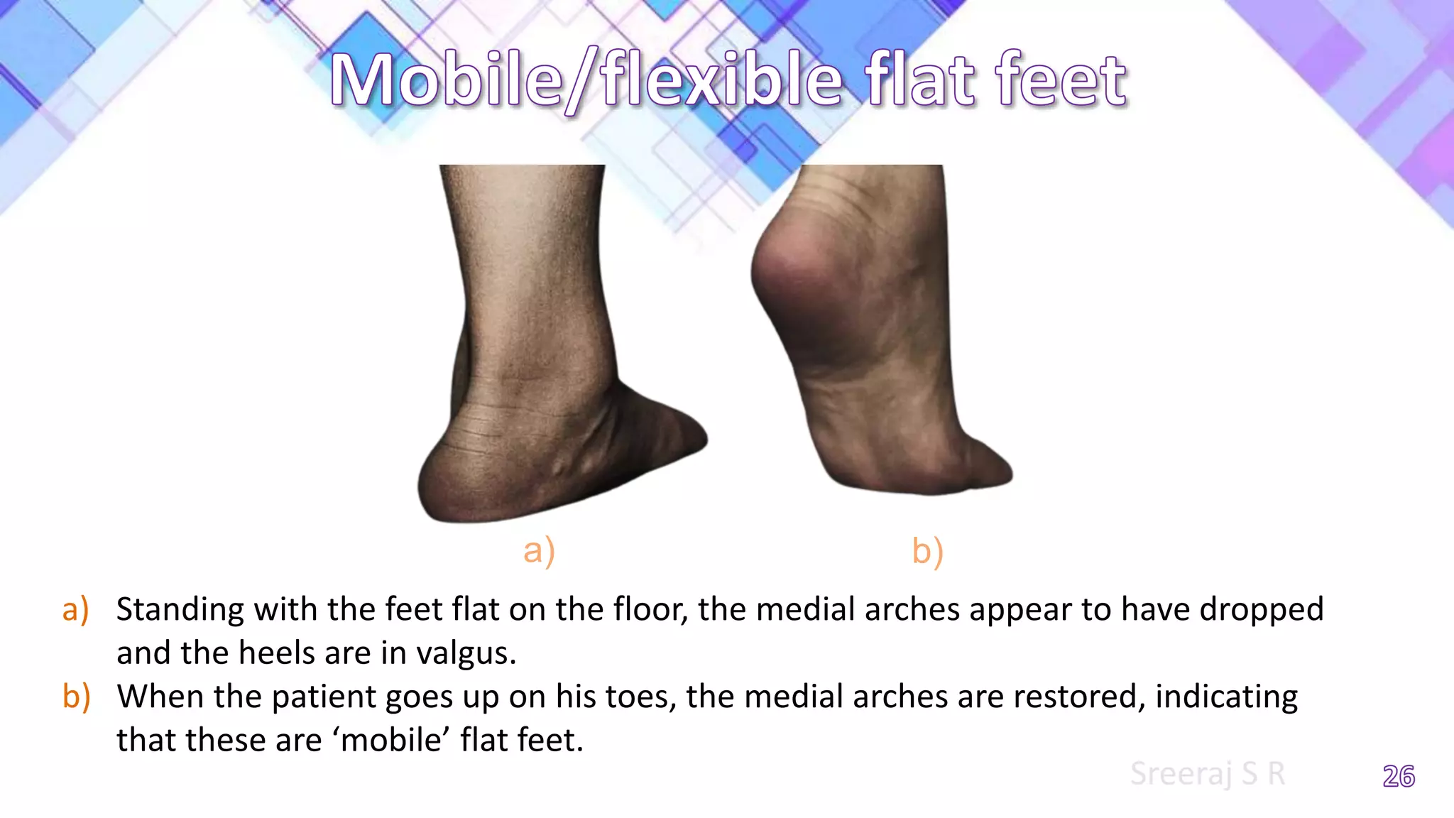 Physiotherapy for ankle & foot deformities | PPTX
