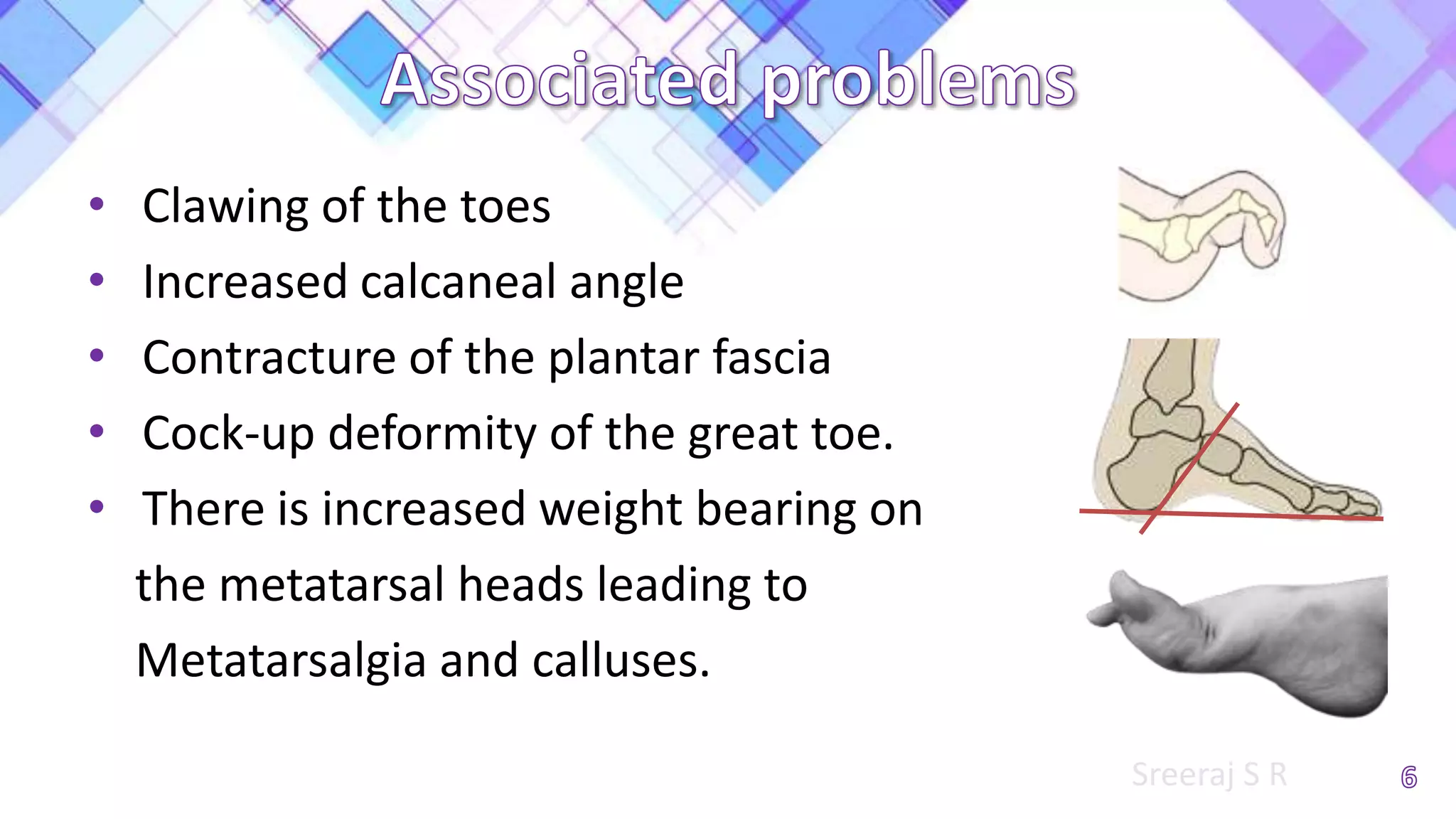 Physiotherapy for ankle & foot deformities | PPTX