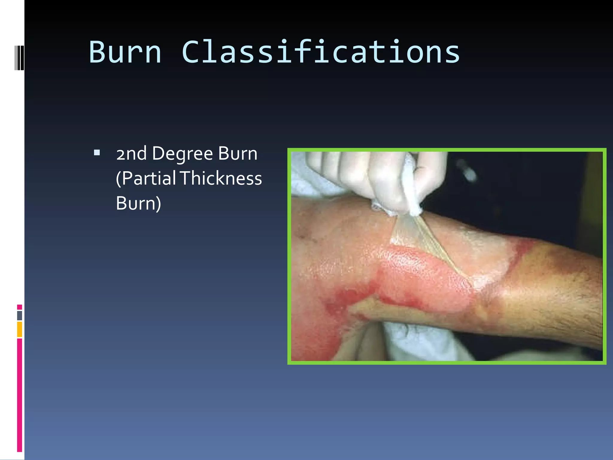 Physiotherapy in burns | PPT