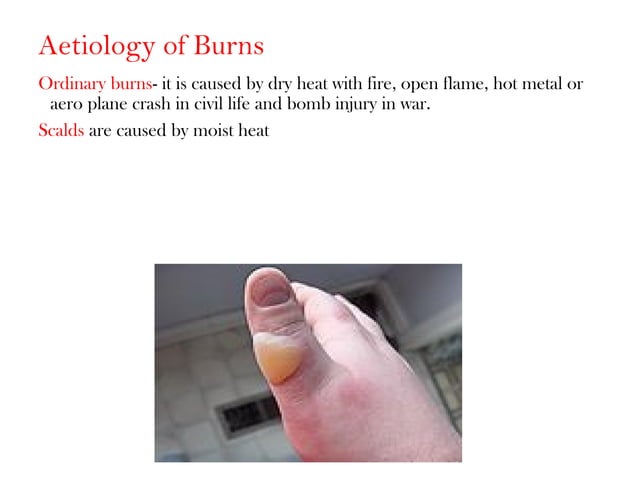 Physiotherapy in burns | PPT | Physical Therapy | Wellness