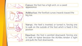 Physiotherapy for CONGENITAL TALIPES EQUINOVARUS | PPTX