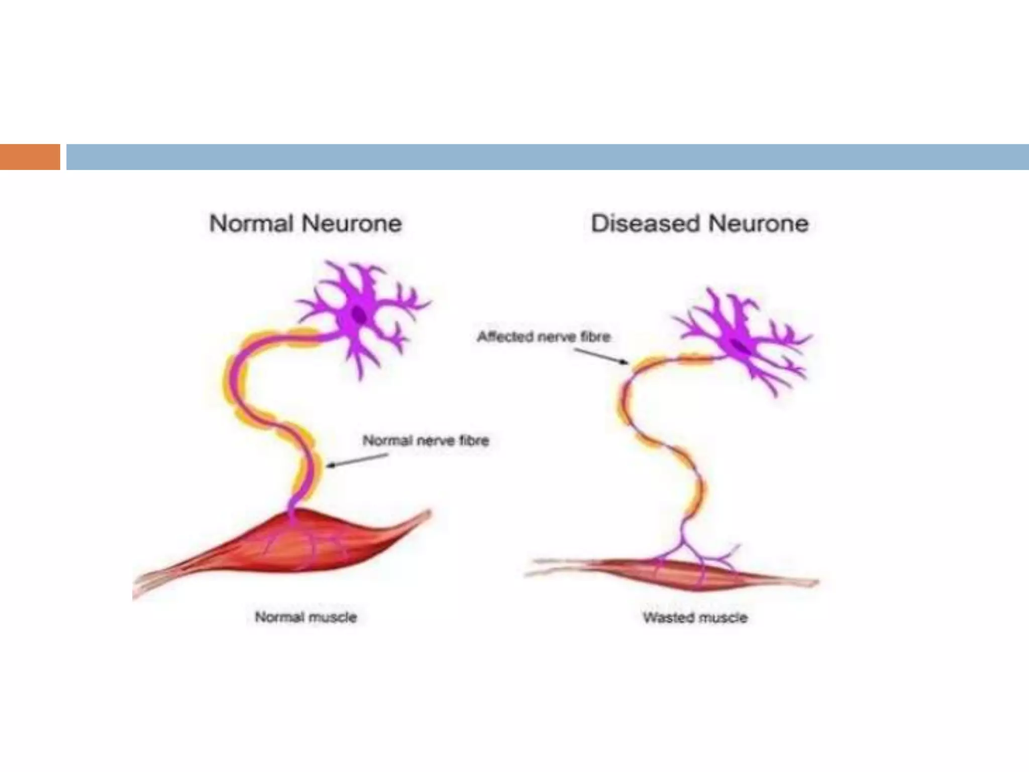 physiotherapy in MND.pptx