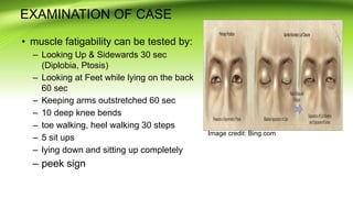 Physiotherapy in Myasthenia Gravis.pdf