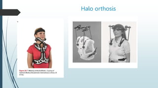 PHYSIOTHERAPY IN SPINAL CORD INJURY (2).pptx