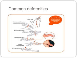 Physiotherapy management for rheumatoid arthritis | PPTX