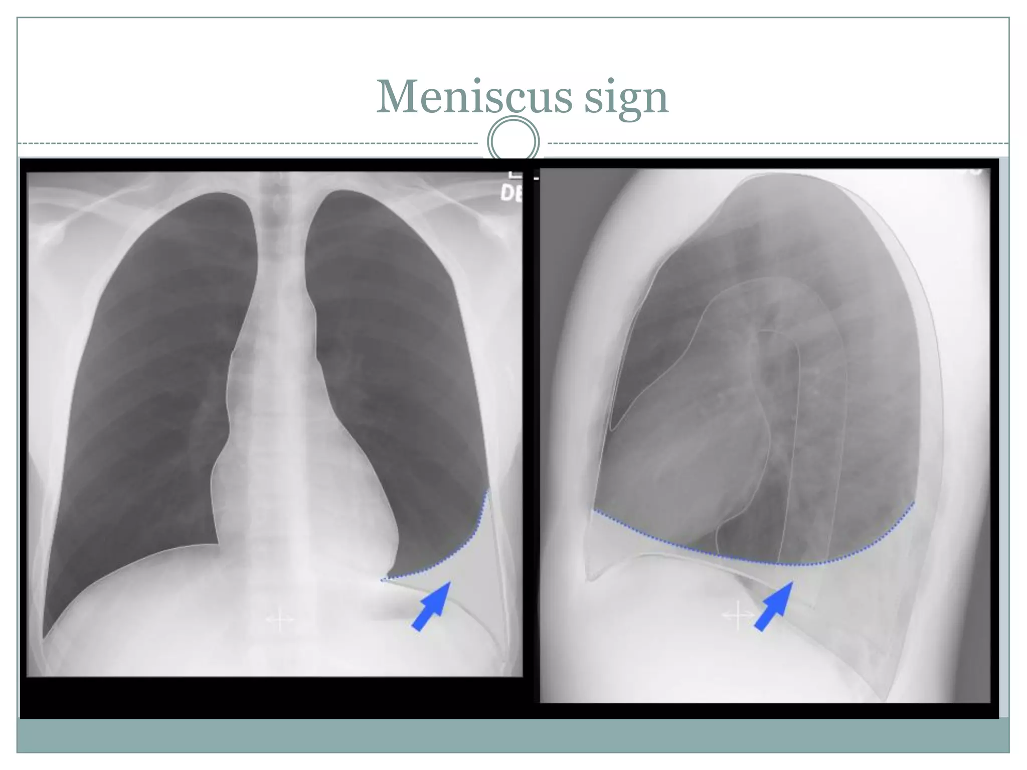 Rehabilitation of patient with pleural effusion | PDF