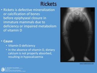 Vit d | PPTX