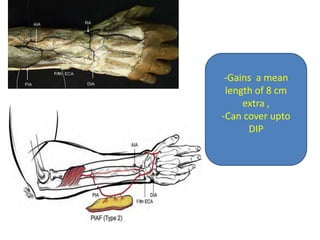 Posterior Interosseous Artery Flap