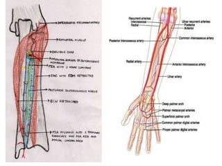 Posterior Interosseous Artery Flap
