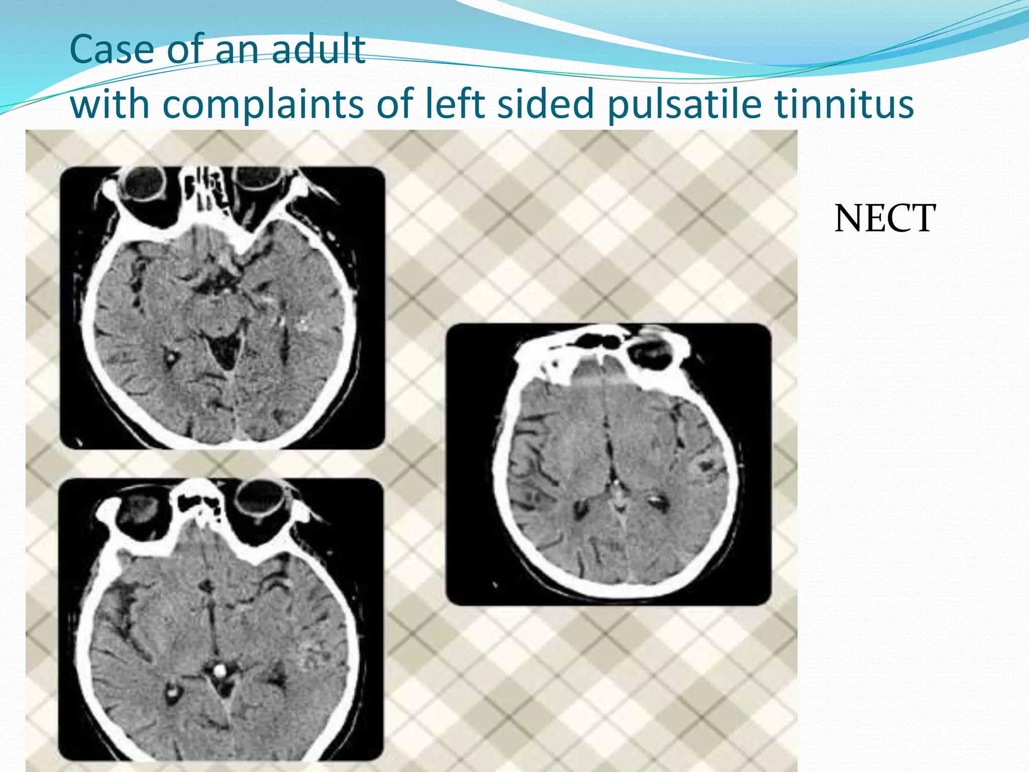 Cerebral/Pial Arteriovenous Malformation (AVM) | PPTX