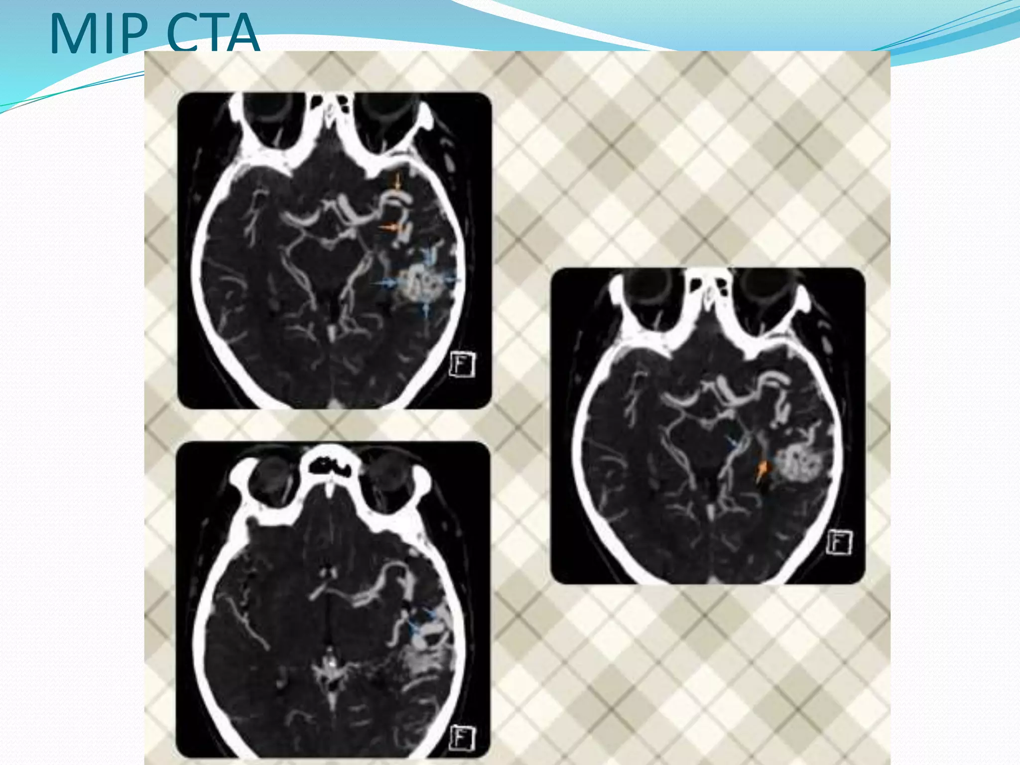 Cerebral/Pial Arteriovenous Malformation (AVM) | PPTX