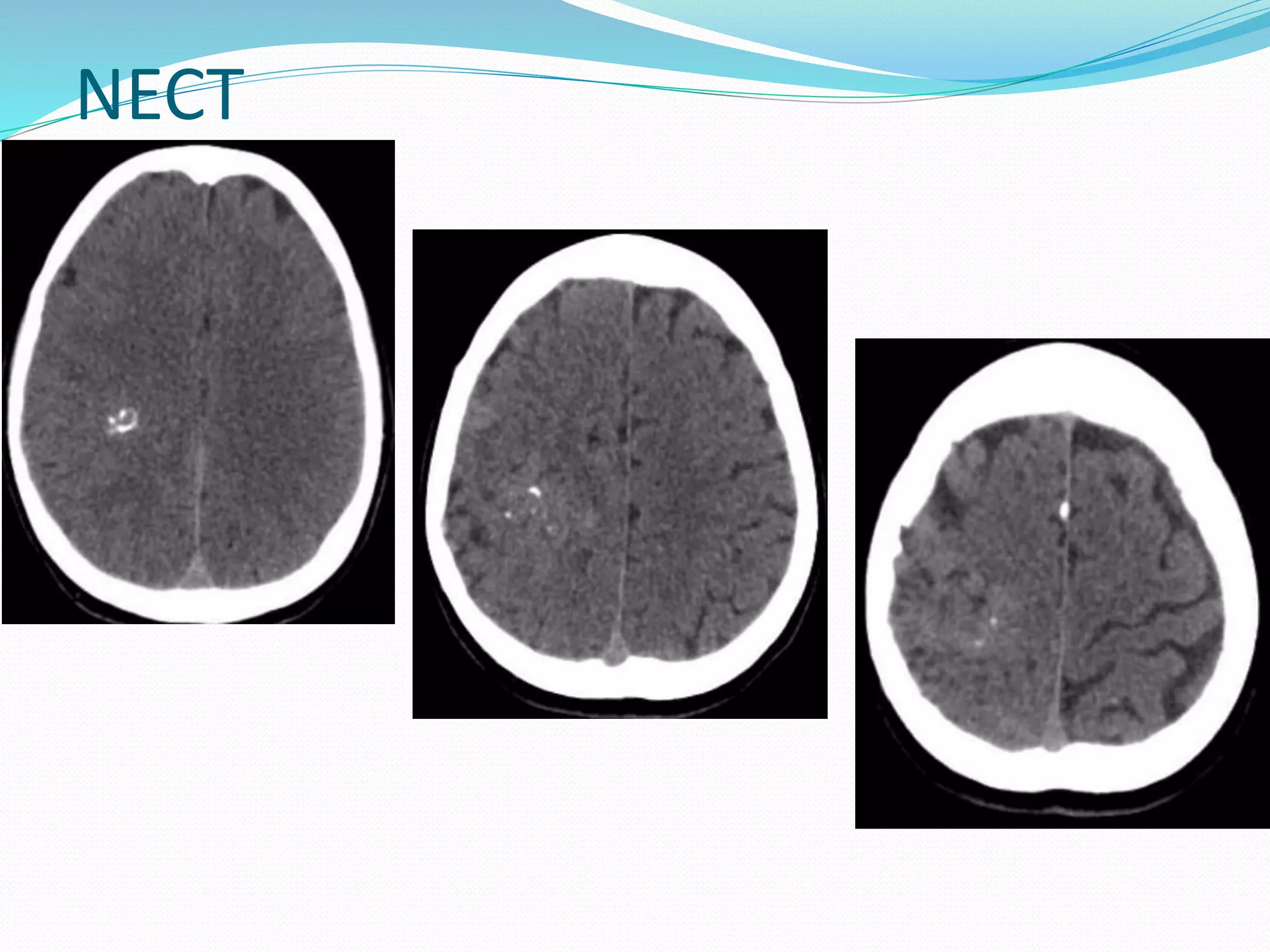 Cerebral/Pial Arteriovenous Malformation (AVM) | PPTX