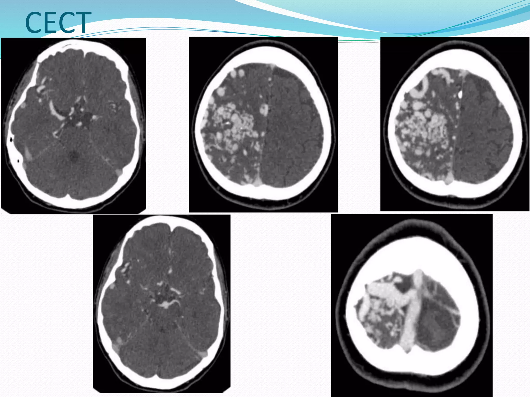 Cerebral/Pial Arteriovenous Malformation (AVM) | PPTX